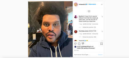 The Weeknd zeigt sich mit Fake-Botox-Gesicht